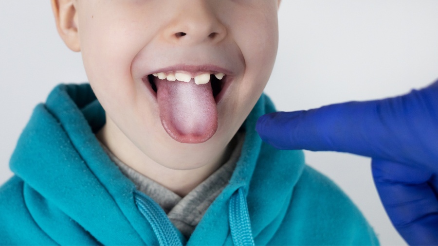 Candida u dziecka- co to, jakie są objawy, jak leczyć? | iZielnik.pl